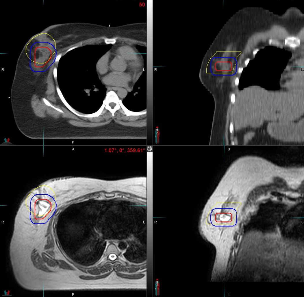 Korean medical center marks one-year anniversary with country’s first Elekta Unity MR-Linac
